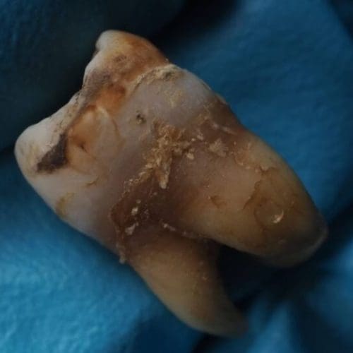 Suboxone Dental Decay Lawsuits | Tooth Loss & Rot Claims